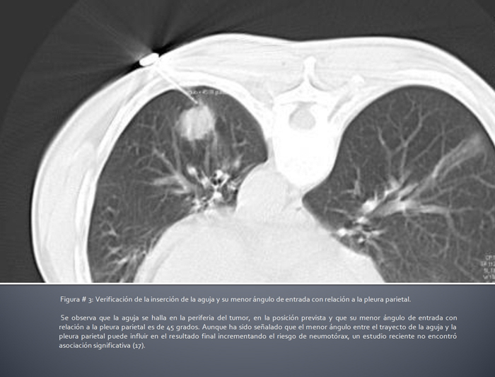 Biopsia transtorácica con aguja guiada por imágenes - Medwave