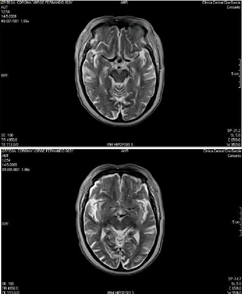 Enfermedad de Cushing en un adulto mayor - Medwave